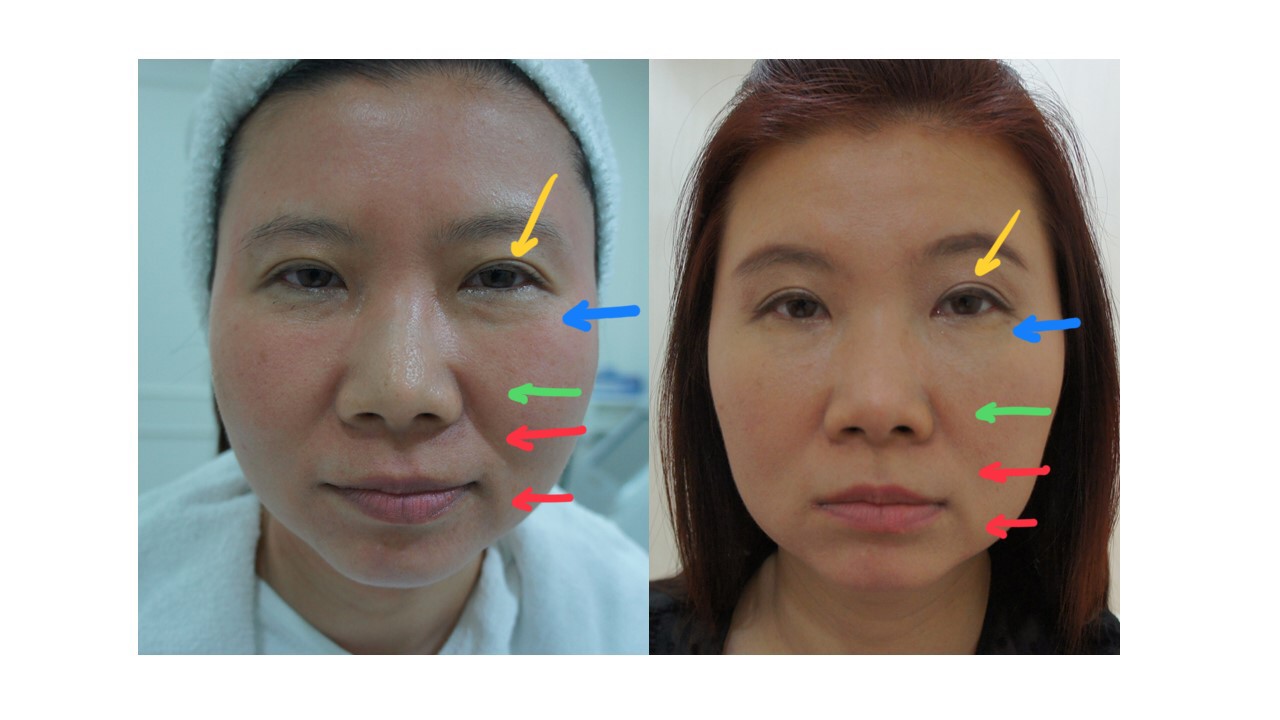 HIFU REVIEW - Piyawat Clinic