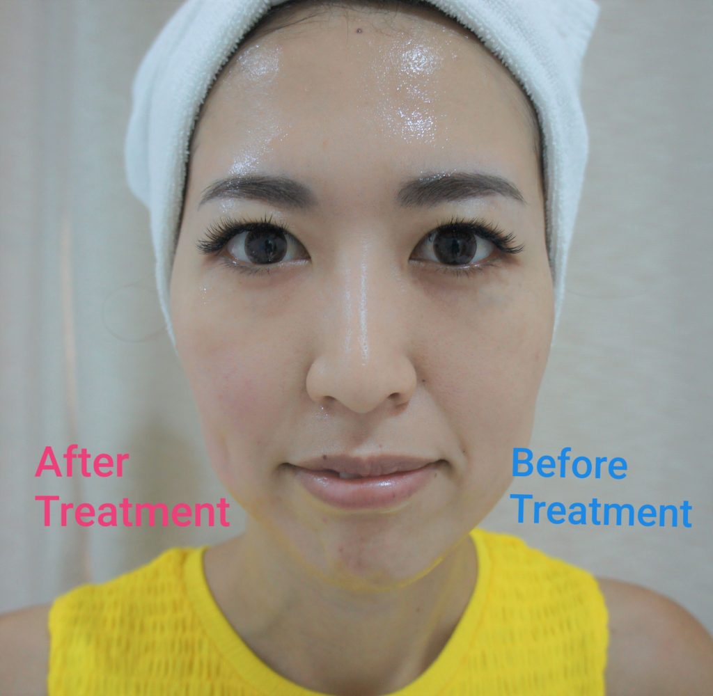 Double Age Lock - Piyawat Clinic