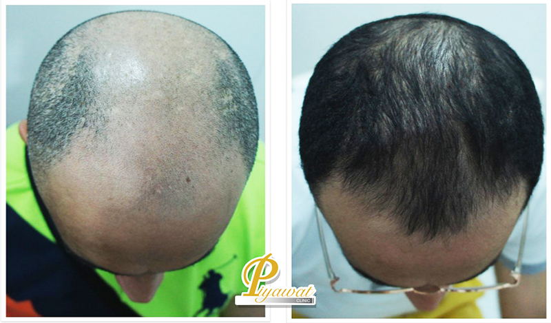 Male Patternjpgweb - Piyawat Clinic