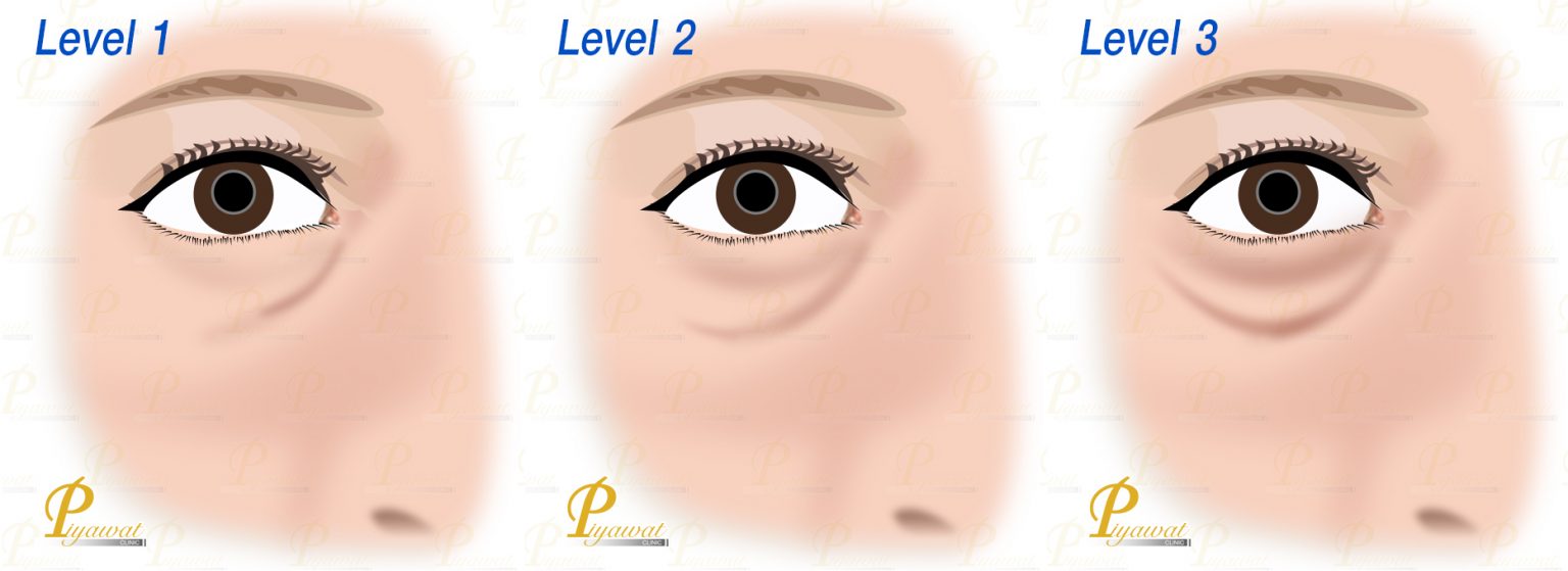 ร่องใต้ตาหรือร่องน้ำตา (Tear trough deformity) - Piyawat Clinic