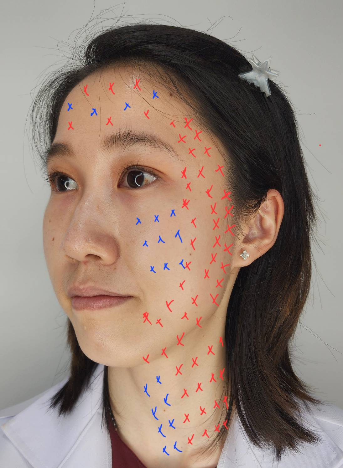 MicroBotox - Piyawat Clinic