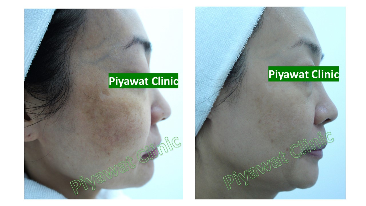 Factor of Melasma Treatment Failure - Piyawat Clinic
